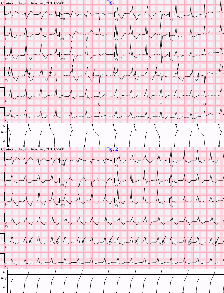 Right Axis Deviation Ecg Guru Instructor Resources 6539